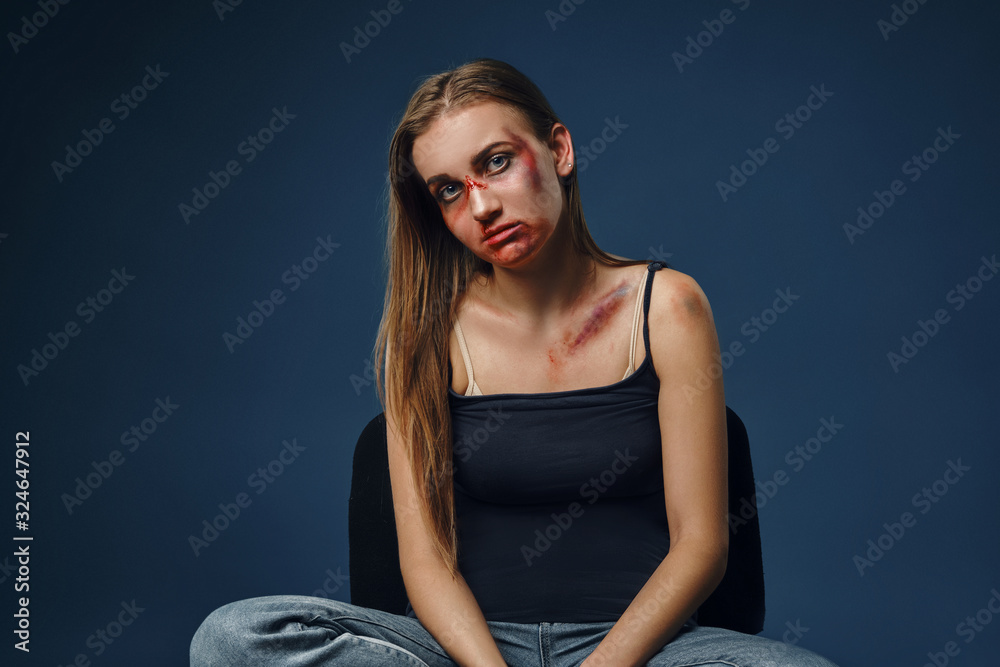 Blonde girl with bruises on her face and chest posing sitting on blue ...