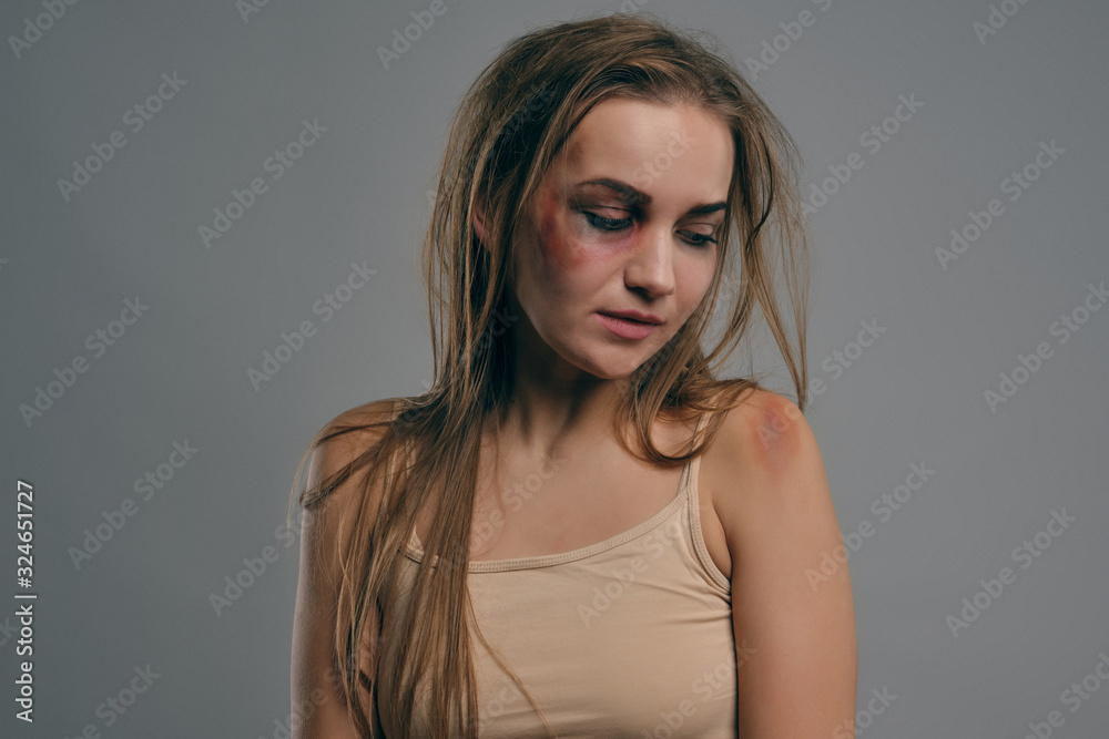 Blonde girl with bruises on her face posing against gray studio ...