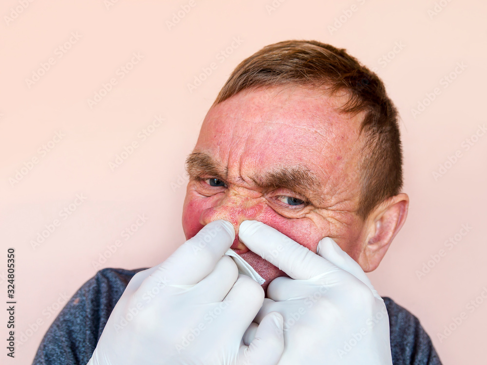 Demodecosis of the face. A man in gloves does the treatment of facial ...