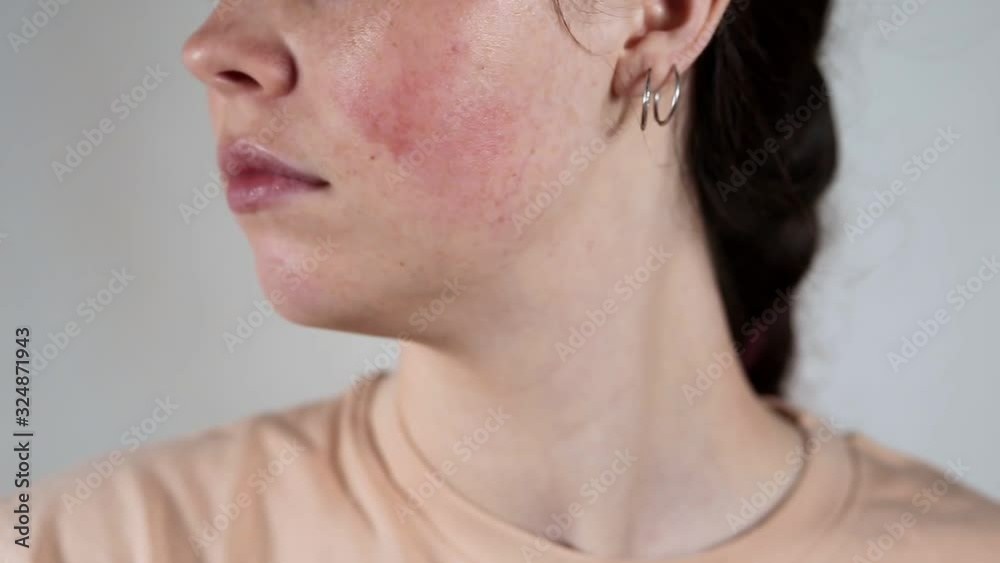 Close up portrait of a young Caucasian woman showing redness and ...