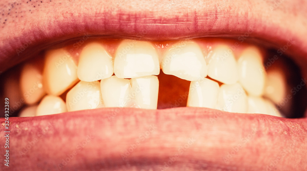 Yellow teeth. Yellow bad teeth. Man without one front tooth. No teeth ...