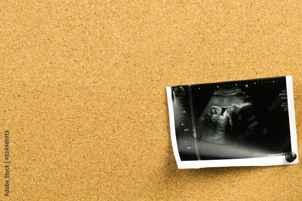 ultrasound pregnancy photo on cork board. Baby fetus photo as a first ...