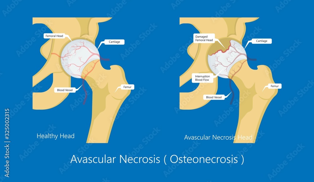Avascular necrosis bone tissue disease Stock Vector | Adobe Stock