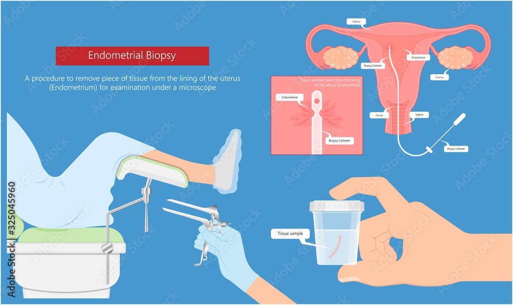 endometrial biopsy examination uterus procedure Stock Vector | Adobe Stock