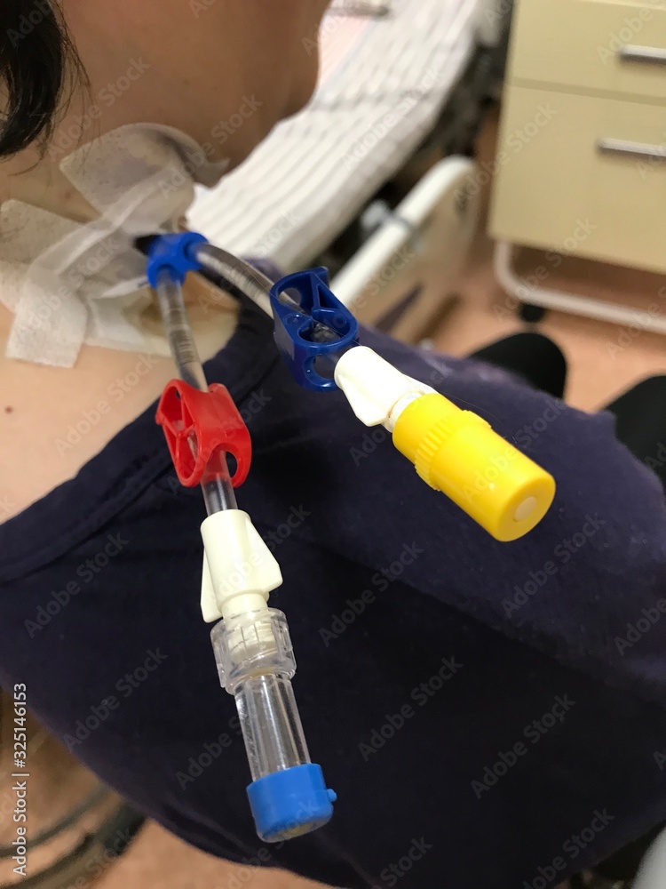 Central venous catheter Stock Photo | Adobe Stock