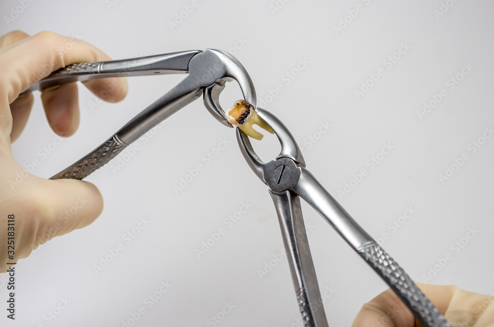 caries-affected destroyed with a large cavity removed human tooth in ...