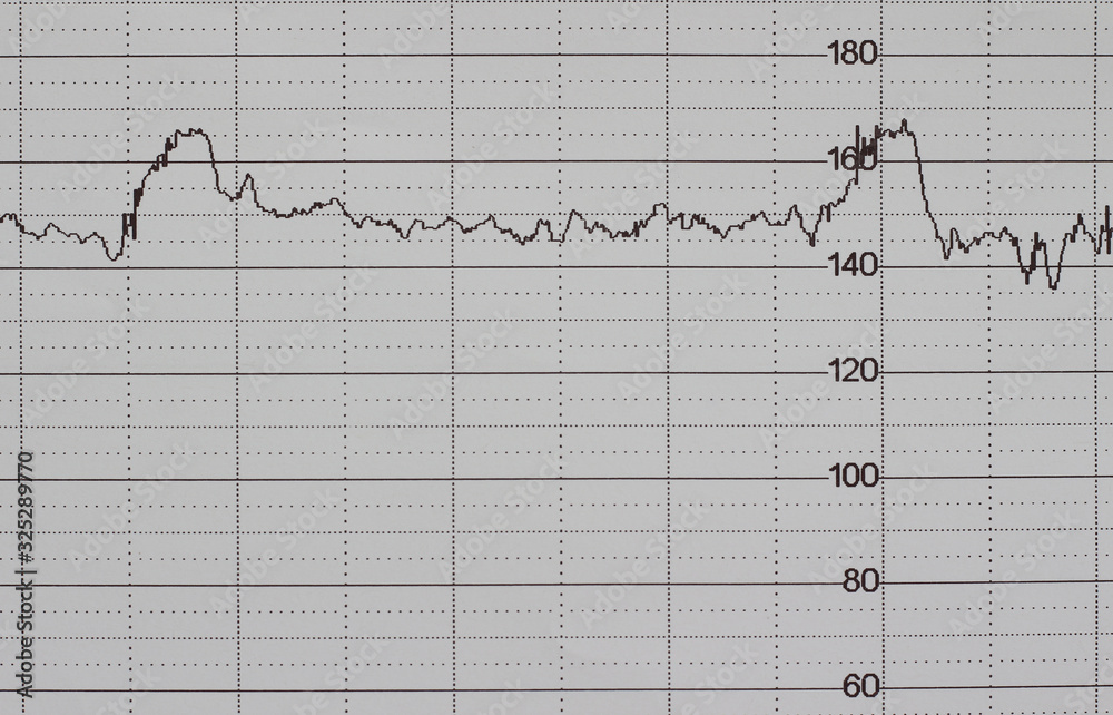 ecg graph, electrocardiogram ekg Stock Photo | Adobe Stock