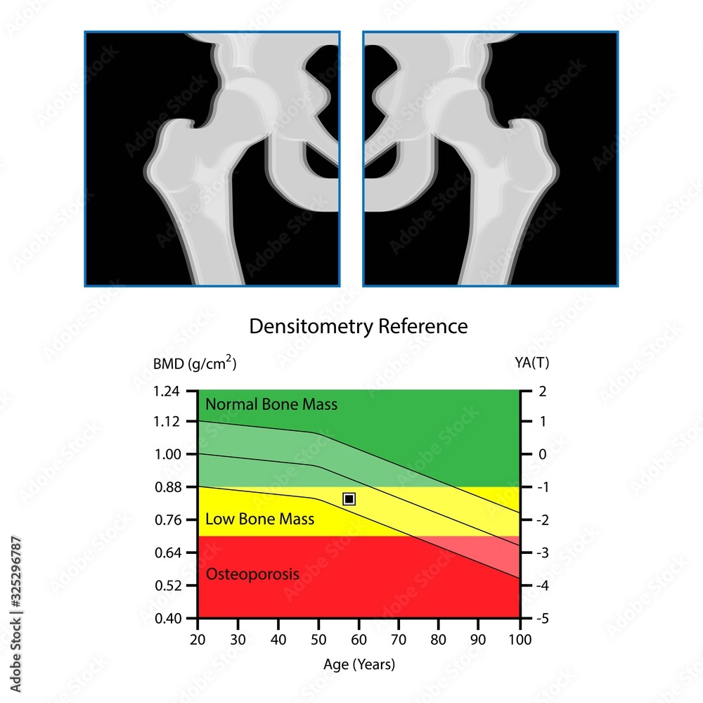 Bone mineral density BMD osteoporosis dual energy X-ray absorptionmetry ...