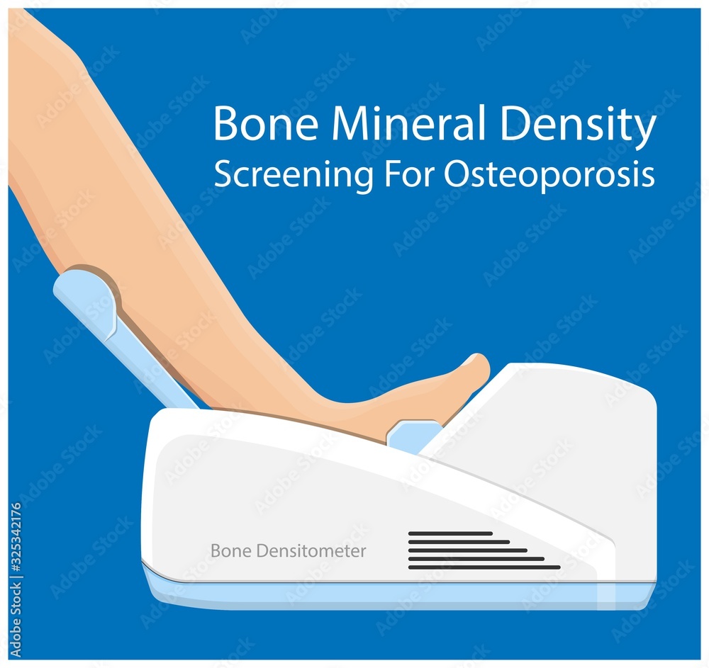 Bone mineral density BMD osteoporosis dual energy X-ray absorptionmetry ...
