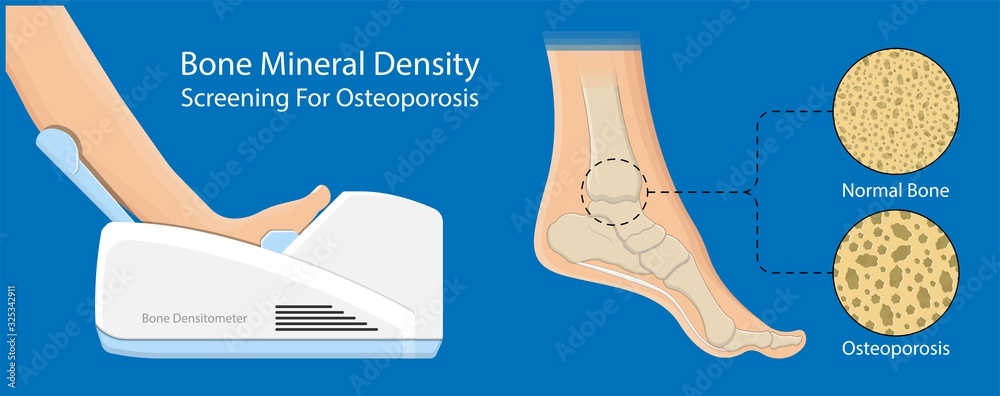 Bone mineral density BMD osteoporosis dual energy X-ray absorptionmetry ...