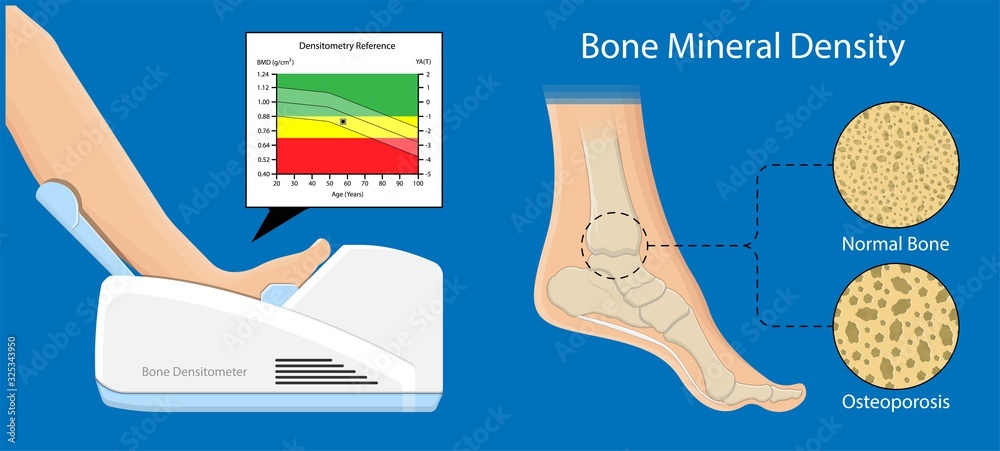 Poster Bone mineral density BMD osteoporosis dual energy X-ray ...