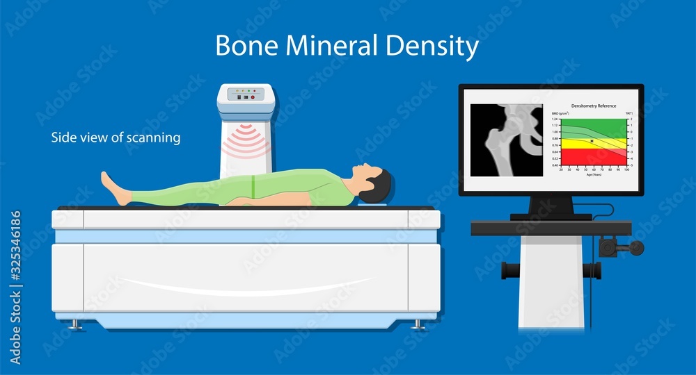 Bone mineral density BMD osteoporosis dual energy X-ray absorptionmetry ...