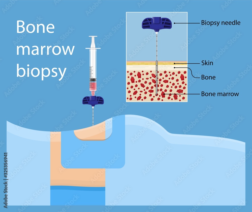 Bone biopsy medical marrow harvest stem cell transplants aspiration ...
