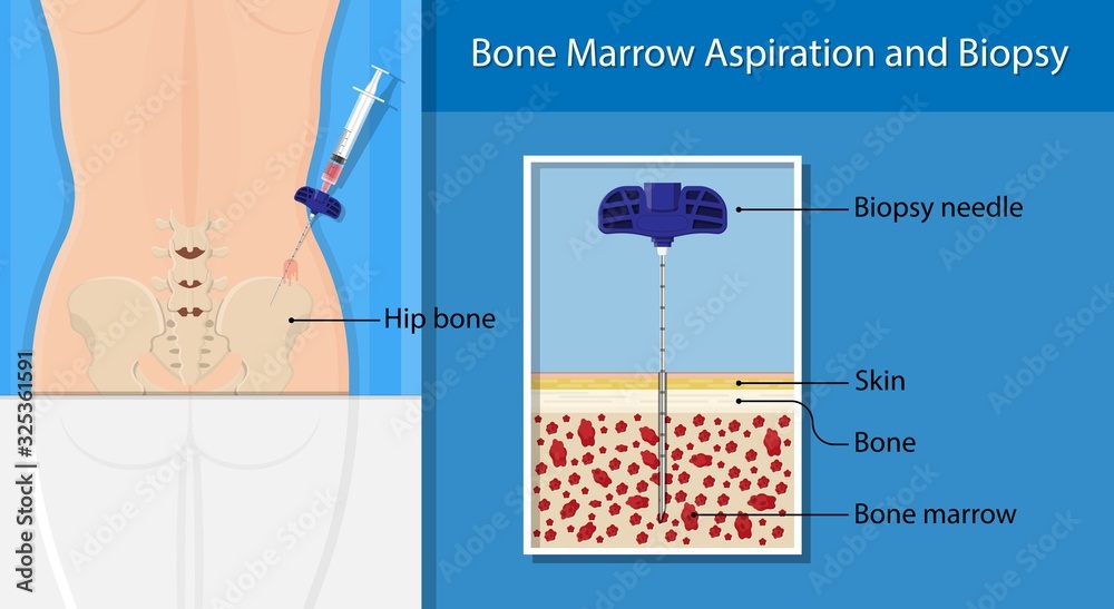 Bone biopsy medical marrow harvest stem cell transplants aspiration ...