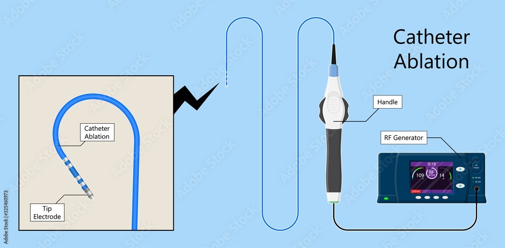 attack Cardiac catheter ablation Atrial fibrillation minimally invasive ...