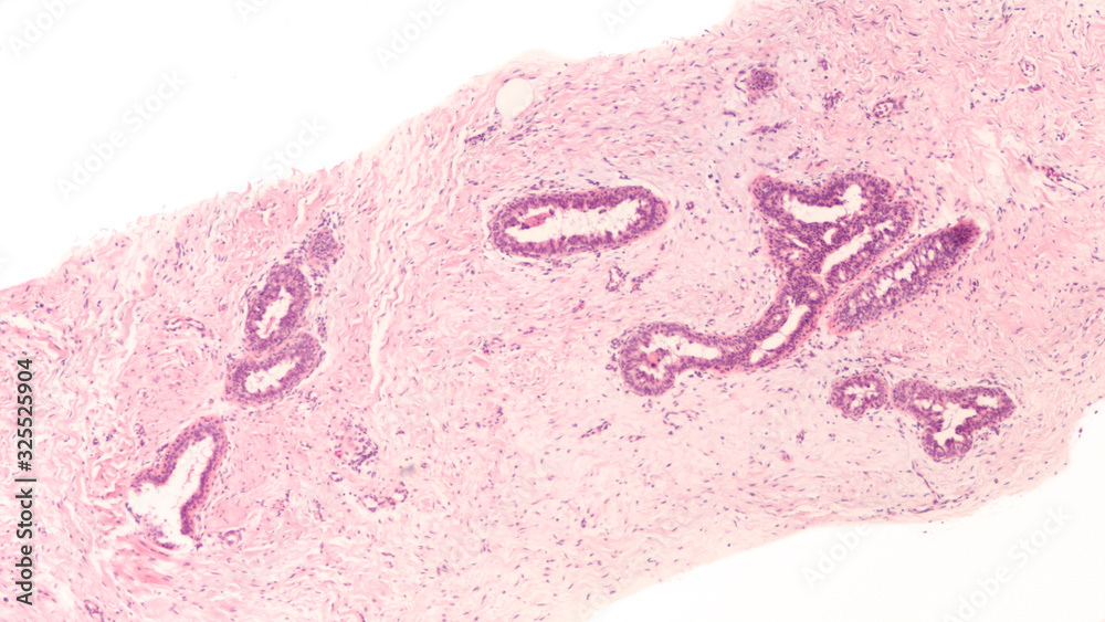 Photomicrograph showing histology of gynecomastia, enlargement of the ...