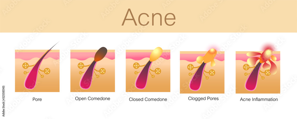 Acne,stages of development,healthy skin,vector design vector de Stock ...