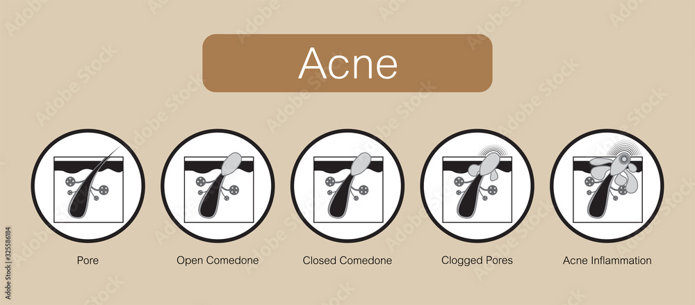 Acne,stages of development,healthy skin,vector design Stock Vector ...