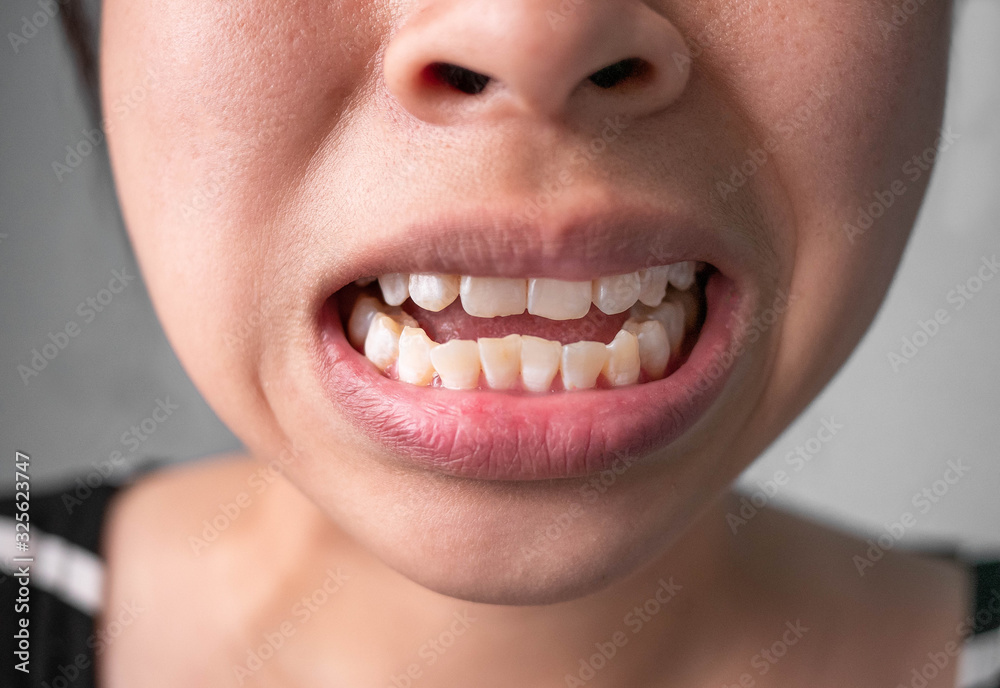 Close-up of a smiling woman's teeth revealing white spots and plaque on ...
