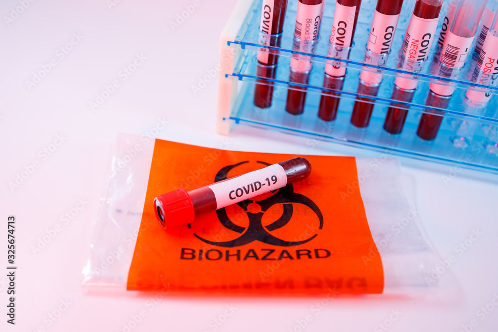 Blood sample for the rapidly spreading Coronavirus that originated in ...