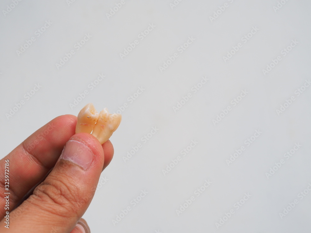 Woman's hand holding tooth after surgery removal of a tooth and white ...
