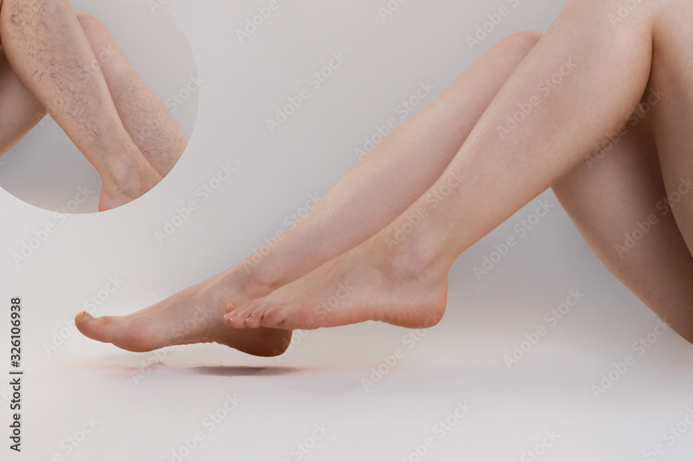 Medicine and health. The concept of female varicose veins. Female legs ...