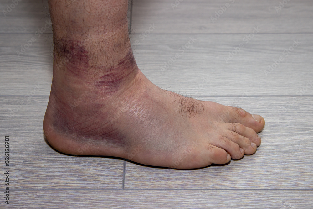 young man with sprained ankle on the floor. Stock Photo | Adobe Stock