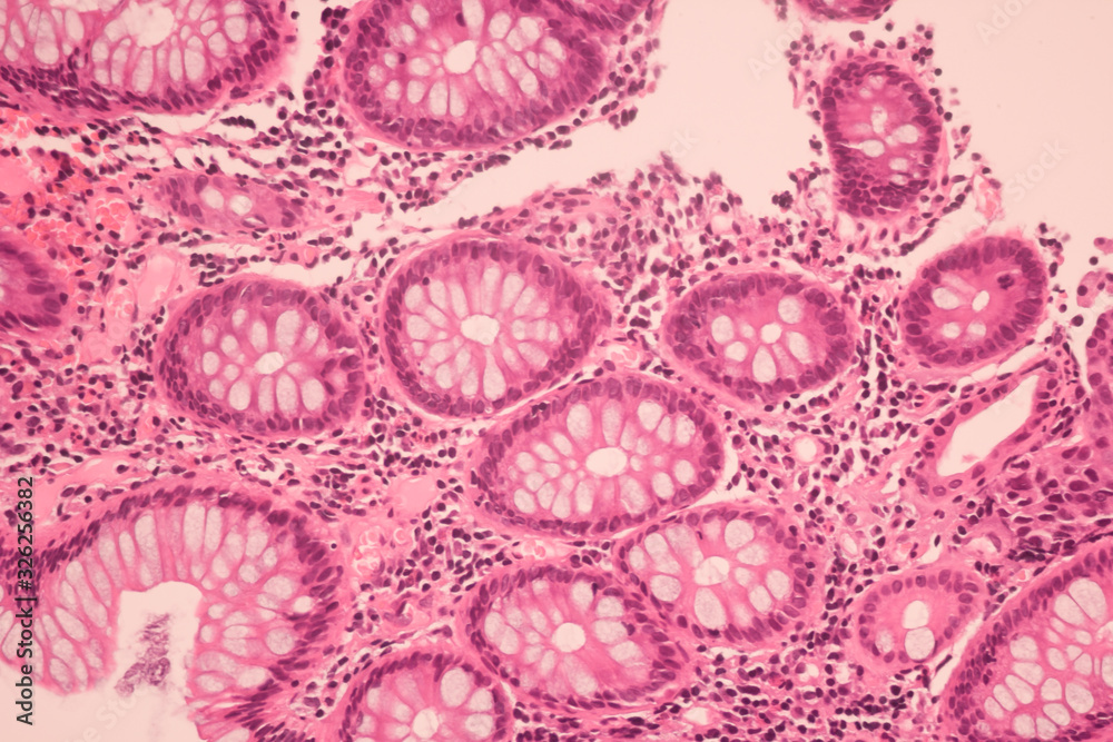 View in microscopic of ductal cell carcinoma, adenonocarcinoma from ...
