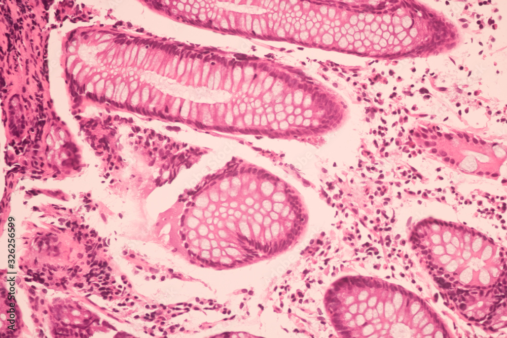 View in microscopic of ductal cell carcinoma, adenonocarcinoma from ...