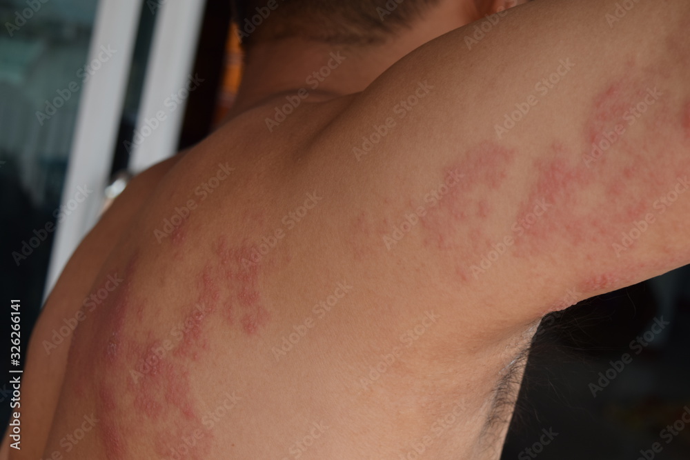 Shingles (Disease),Herpes zoster, severe dermatitis due to a viral ...