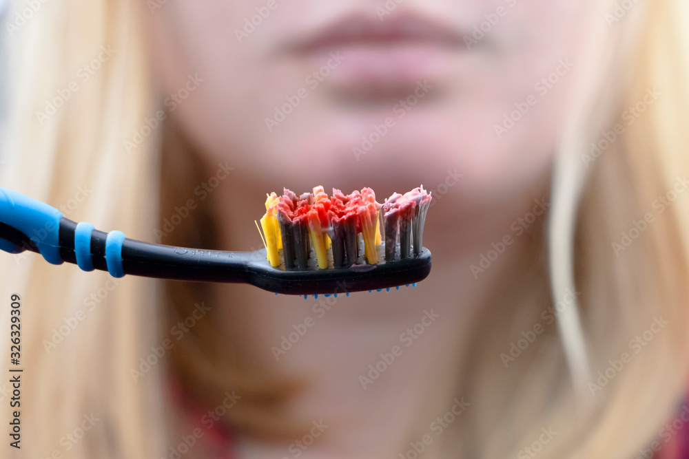 Toothbrush with blood closeup. A woman discovered bleeding gums while ...