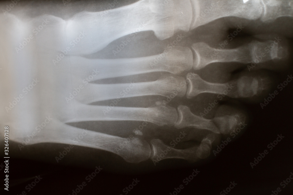 X-ray of the foot with a fracture of the toe Stock Photo | Adobe Stock