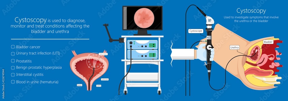 Cystoscopy diagnose bladder diseases and conditions exam treat benign ...