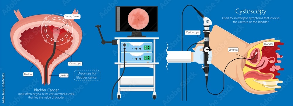 Cystoscopy diagnose bladder diseases and conditions exam treat benign ...