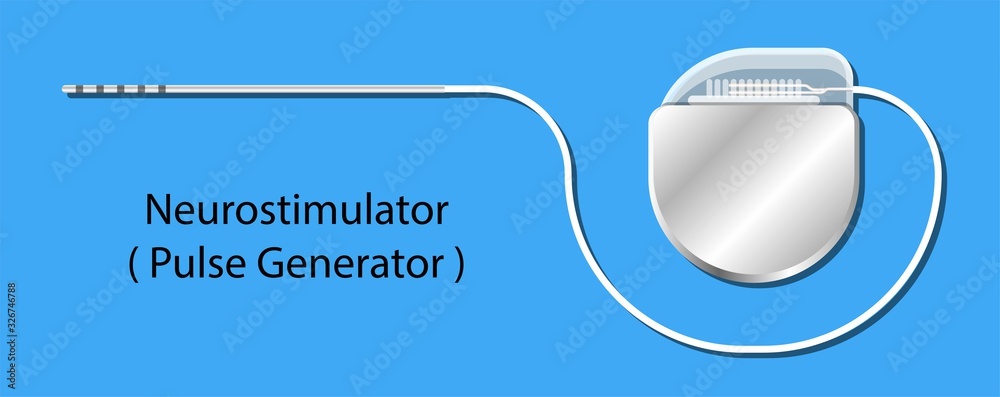 Deep brain stimulation treatment patient disease medical Stock Vector ...