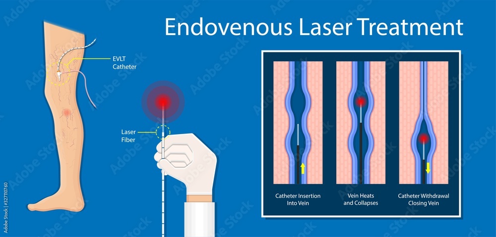 endovenous laser treatment CVD treat ELT legs inject EVLT varicose ...