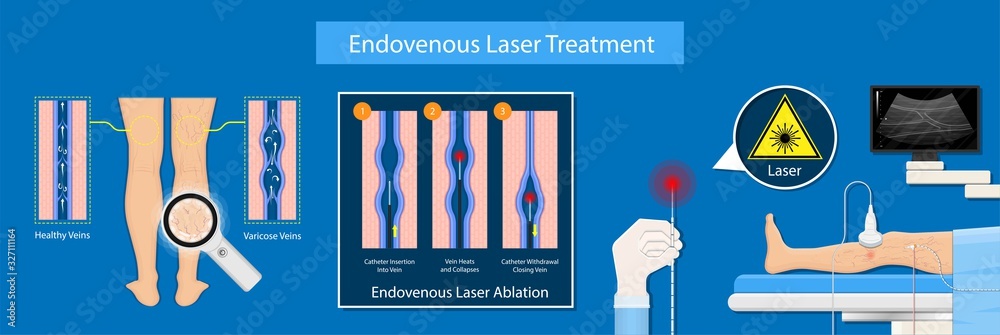 endovenous laser treatment CVD treat ELT legs inject EVLT varicose ...