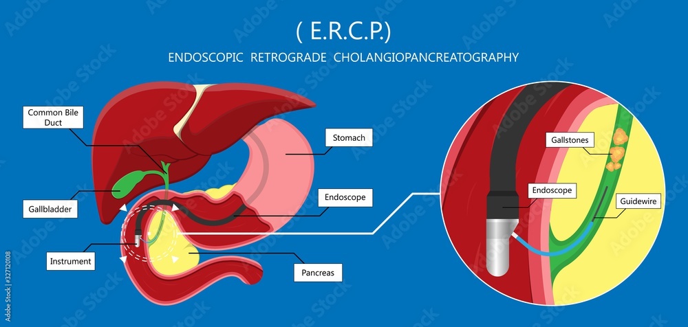 Endoscopic Retrograde Cholangiopancreatography ERCP diagnose treat ...
