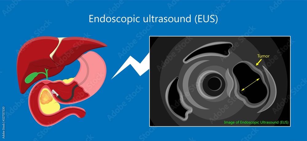 medical endoscopic ultrasound EUS cancer tumor diagnose FNA abdominal ...
