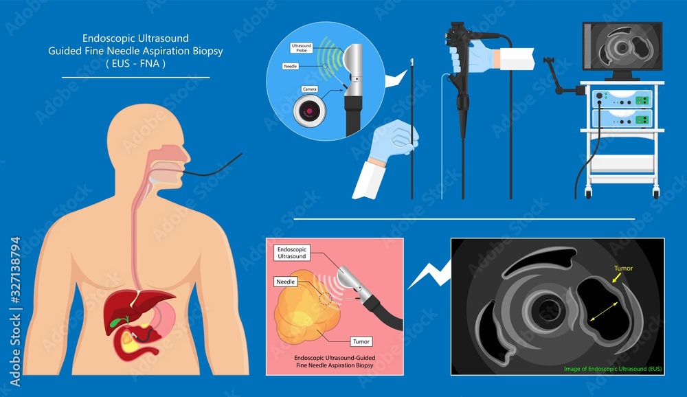 medical endoscopic ultrasound EUS cancer tumor diagnose FNA abdominal ...
