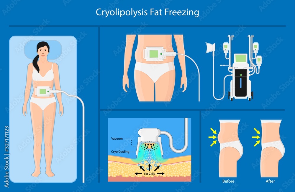 cryolipolysis fat freezing procedure cold treatment non invasive medication reduce temperature ...
