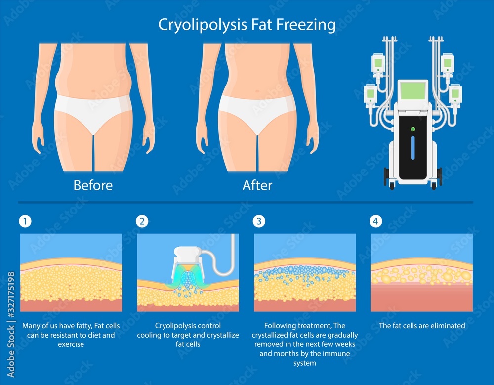 cryolipolysis fat freezing procedure cold treatment non invasive medication reduce temperature ...
