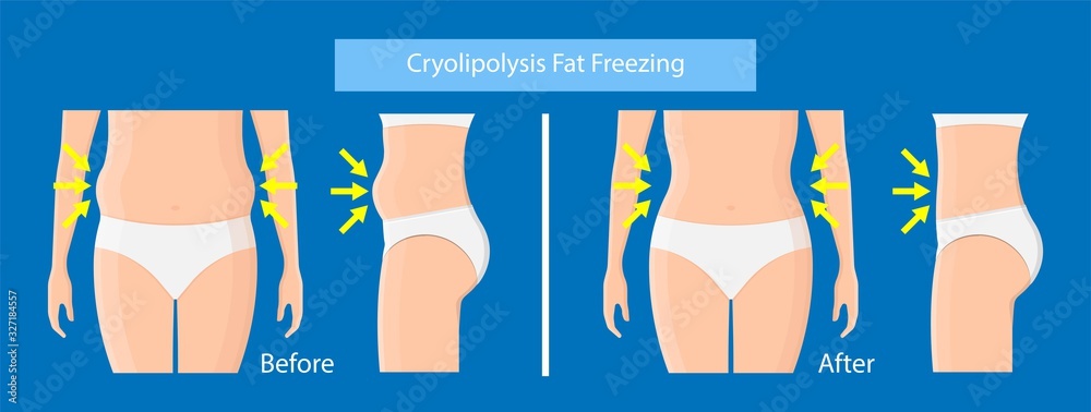 Freezing Liposuction Procedures