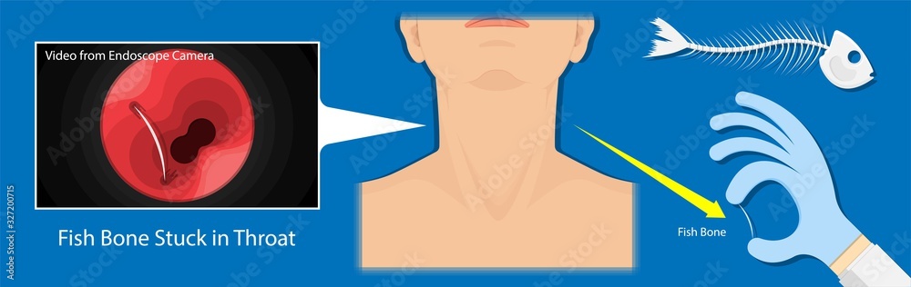 Fish Bone Stuck Throat accidental ingestion painful difficulty ...