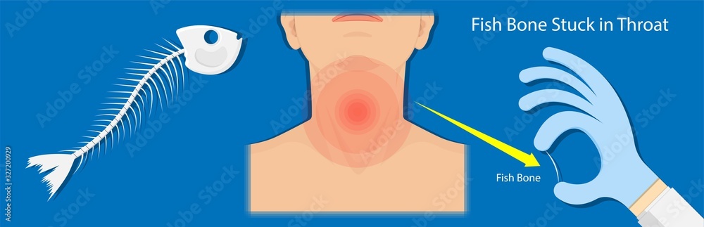 Fish Bone Stuck Throat accidental ingestion painful difficulty ...