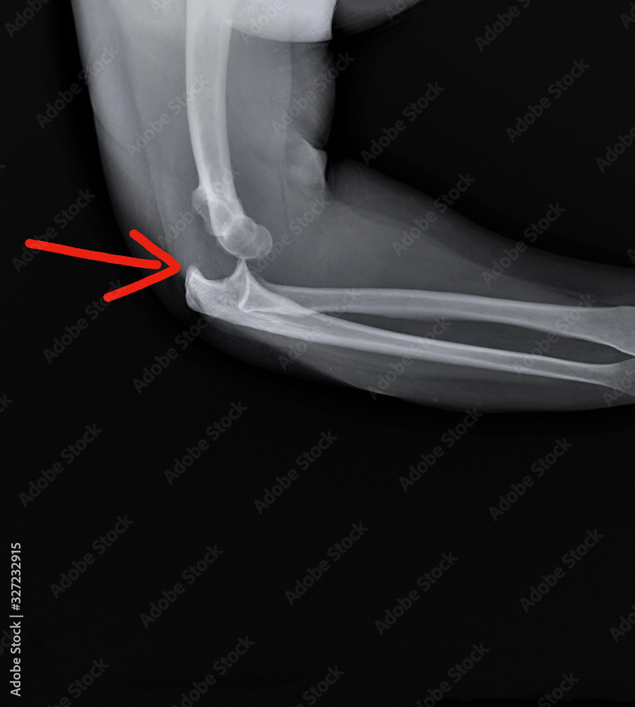 Fotografía x- ray of the elbow joint with dislocation of the forearm ...