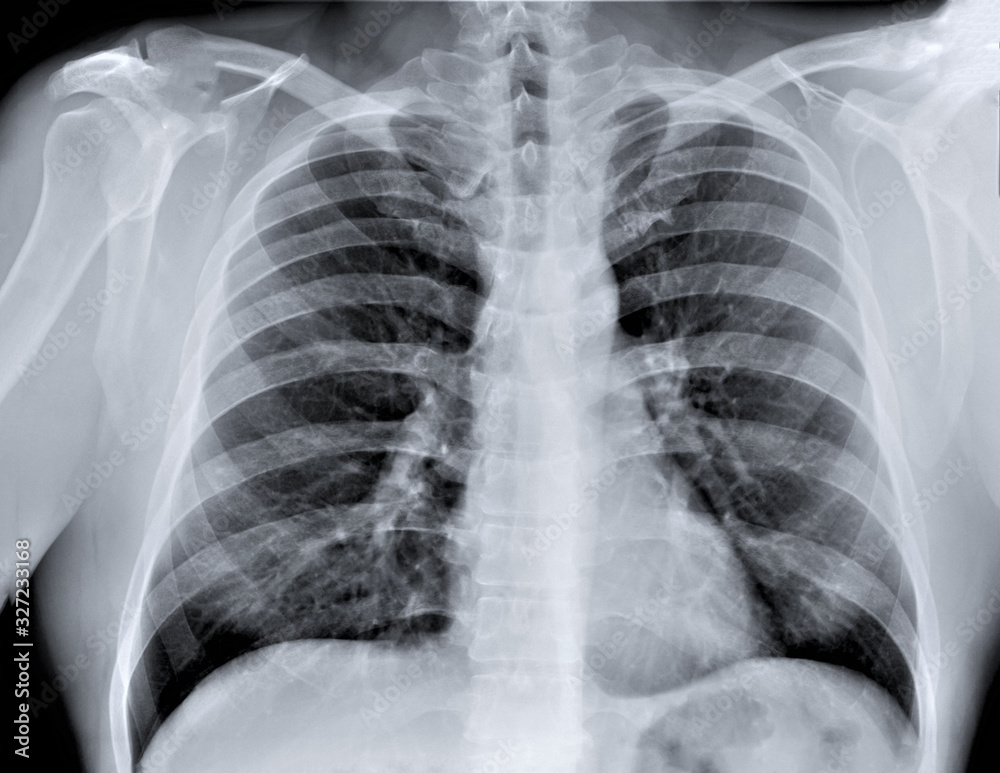 chest x-ray, diagnosis of coronavirus pneumonia Stock Photo | Adobe Stock