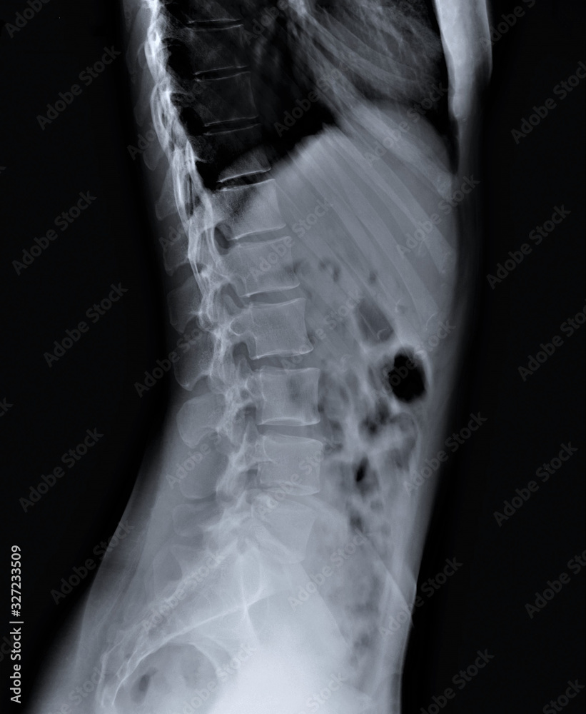 x- ray of the lumbar spine in the lateral projection Stock Photo ...