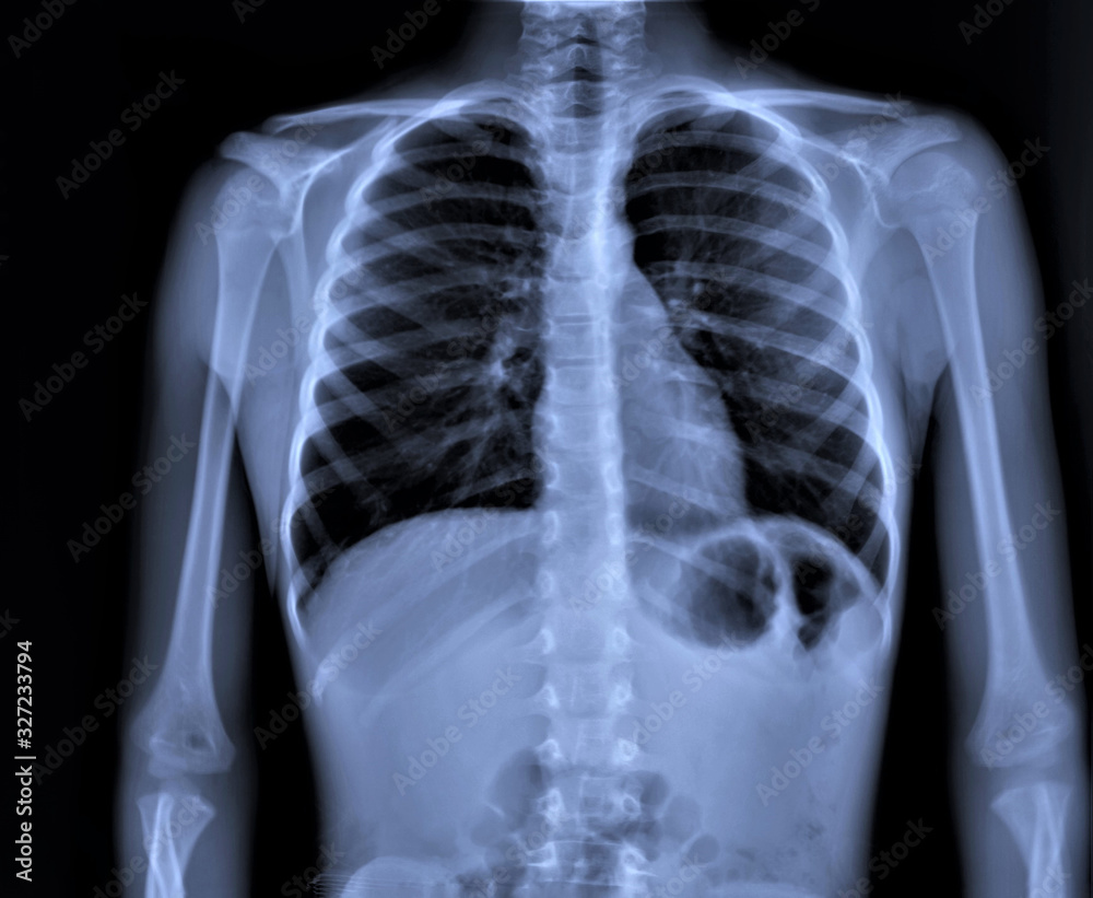 chest x-ray, diagnosis of coronavirus pneumonia Stock Photo | Adobe Stock