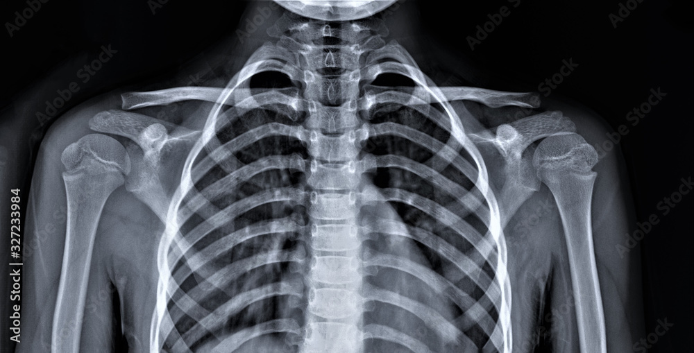 chest x-ray, diagnosis of coronavirus pneumonia Stock Photo | Adobe Stock